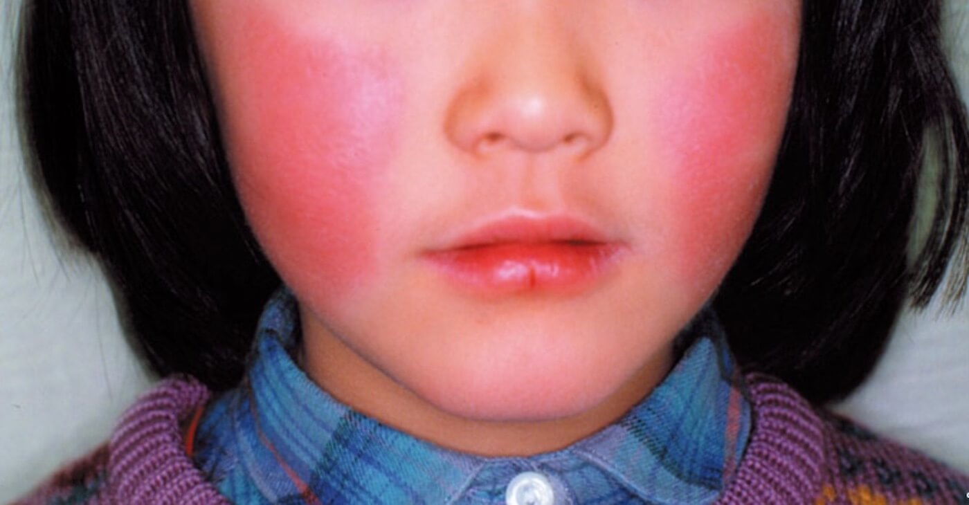 Record Rise in Apple Disease Cases in Fukuoka | Fukuoka Now